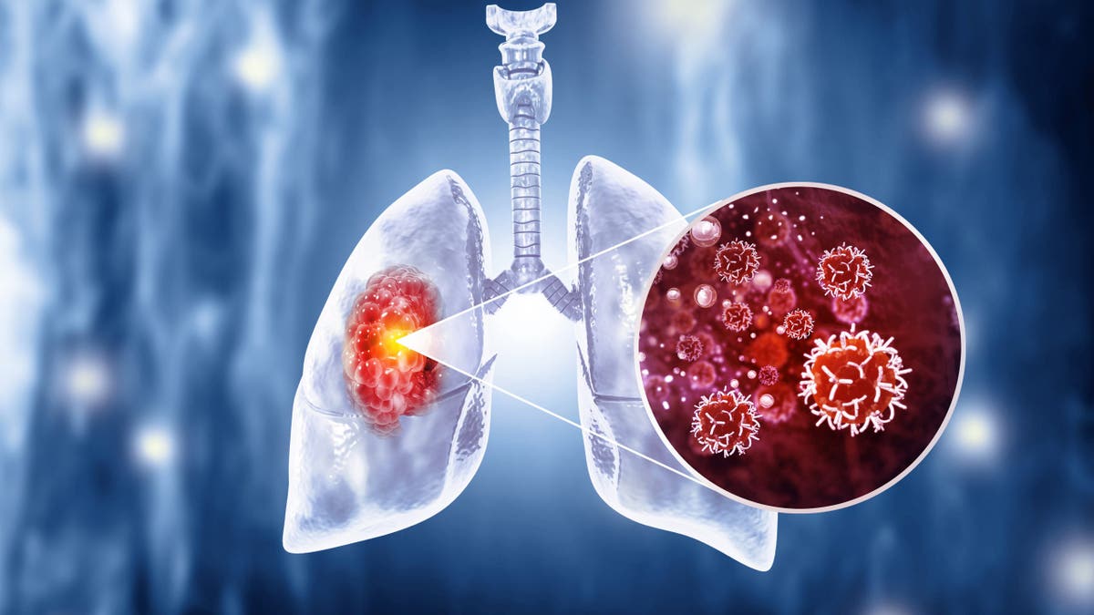 Risks, symptoms and treatments for lung cancer, the deadliest cancer in ...